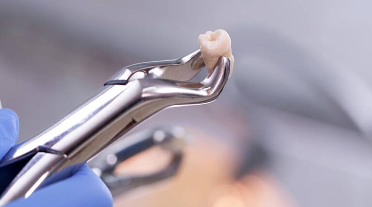 After Wisdom Tooth Removal | Oral Surgeon Deer Park | Oral Surgeon ...