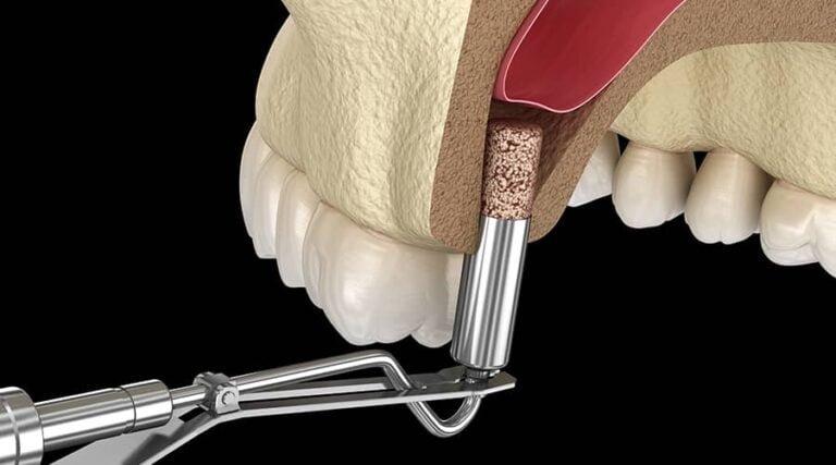 Sinus Lift | Oral Surgeon Deer Park | Oral Surgeon Barrington | Dental ...